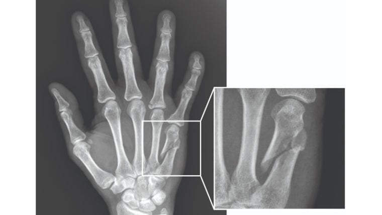 Fractures of the hand – Julian Carlo, MD.